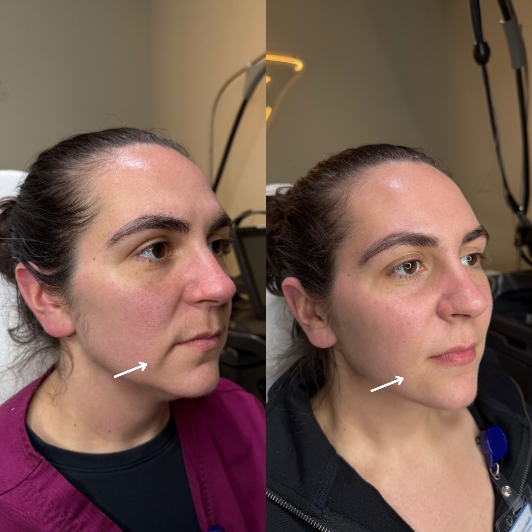 Marionette Line Filler - Muse Medical Aesthetics